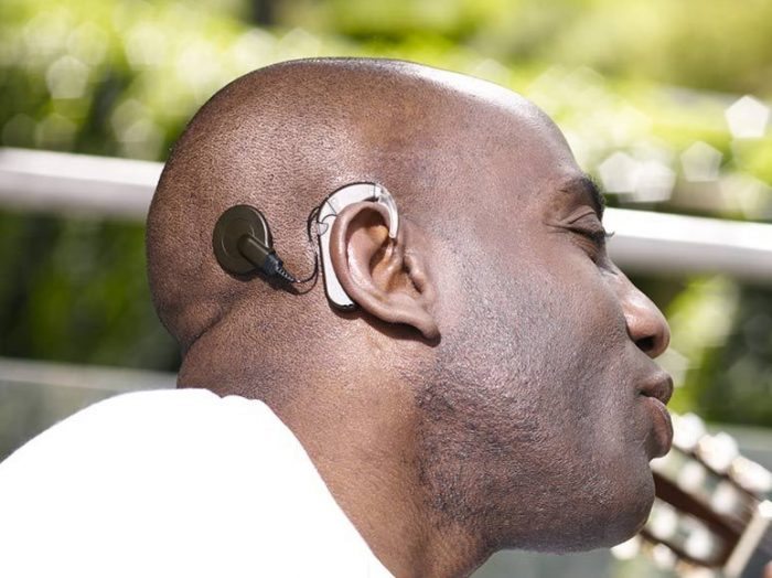 Implante Coclear - Preço, Valor e Tudo o Que Precisa Saber